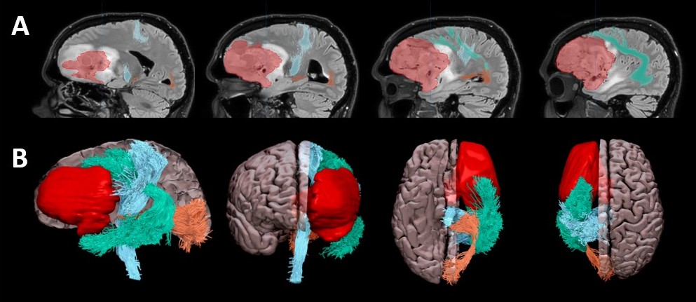 Diffusion MRI tractography to reduce risks of postoperative ...